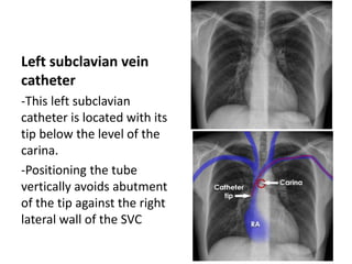 Left Subclavian Vein Central Line