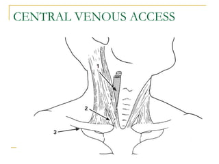 Central venous access 19 march | PPT