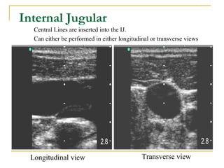 Central venous access 19 march | PPT