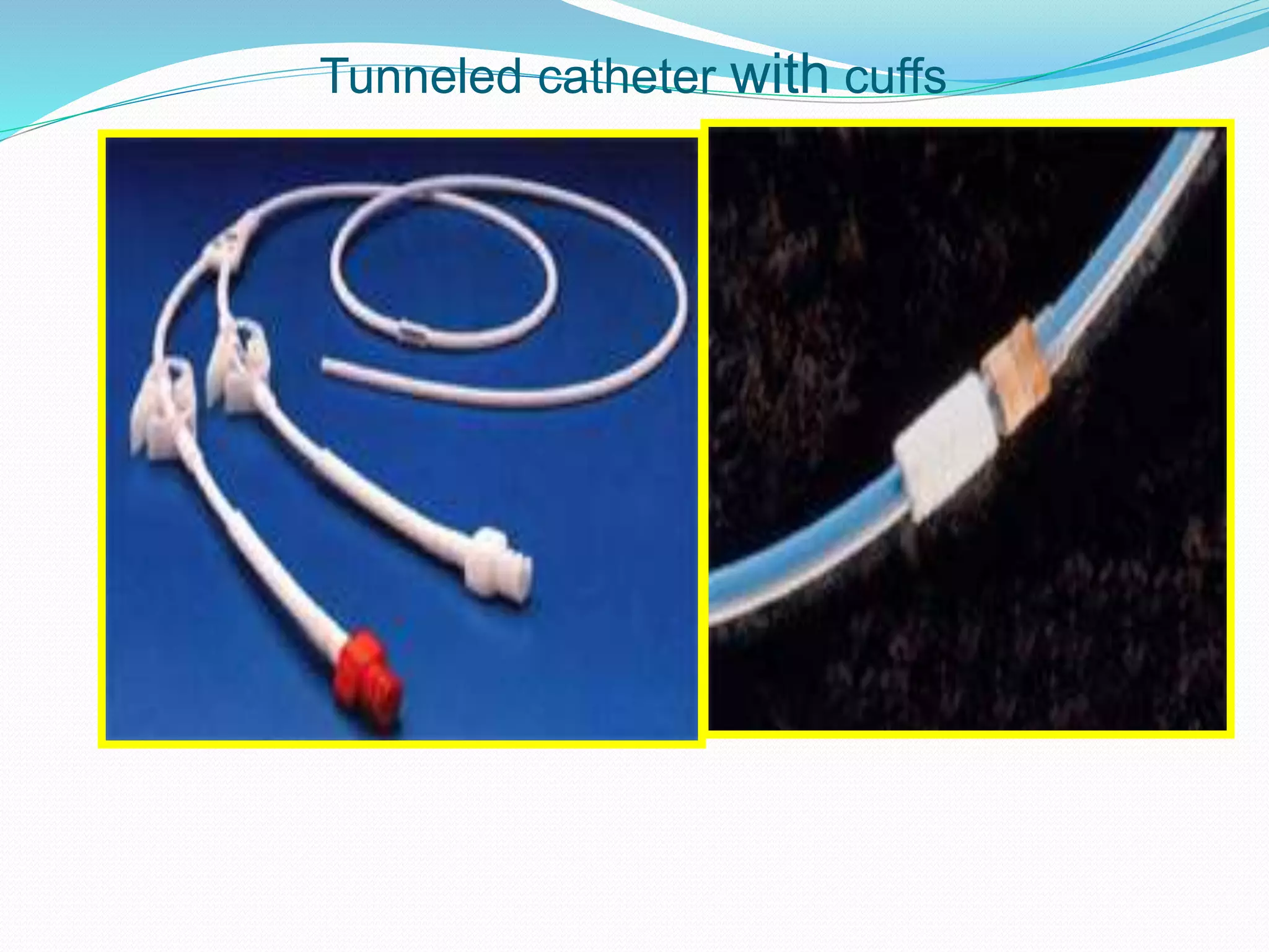 Central venous access catheter | PPTX