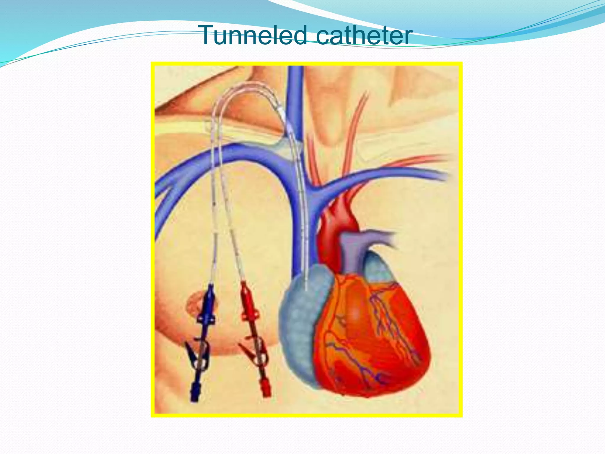 Central venous access catheter | PPTX