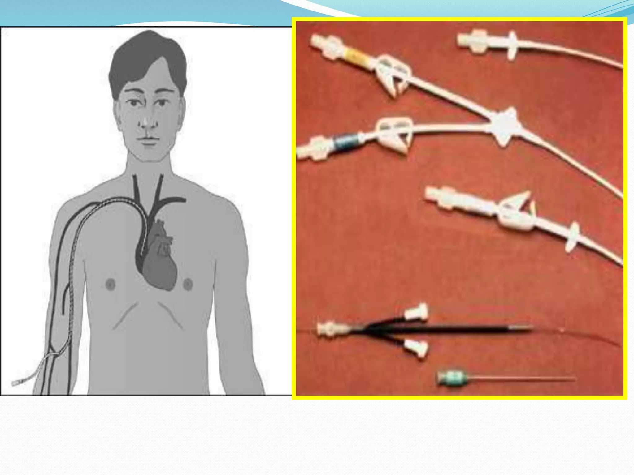 Central venous access catheter | PPTX
