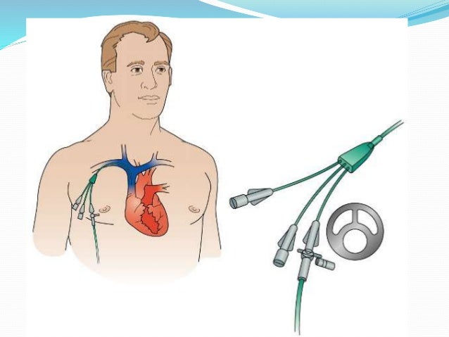 3 Types Of Vascular Access Ports Used In Hemodialysis