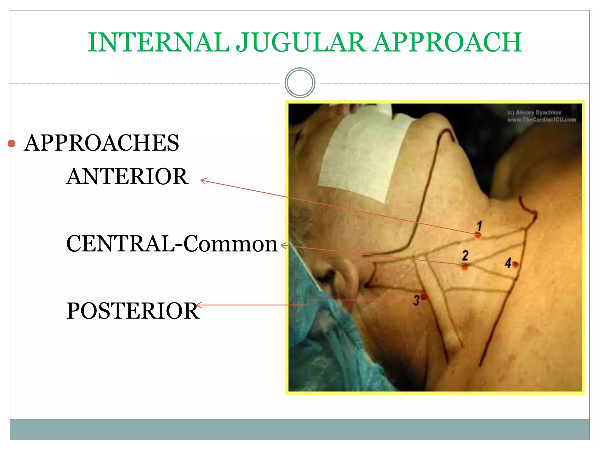 Central venous cannulation | PPTX