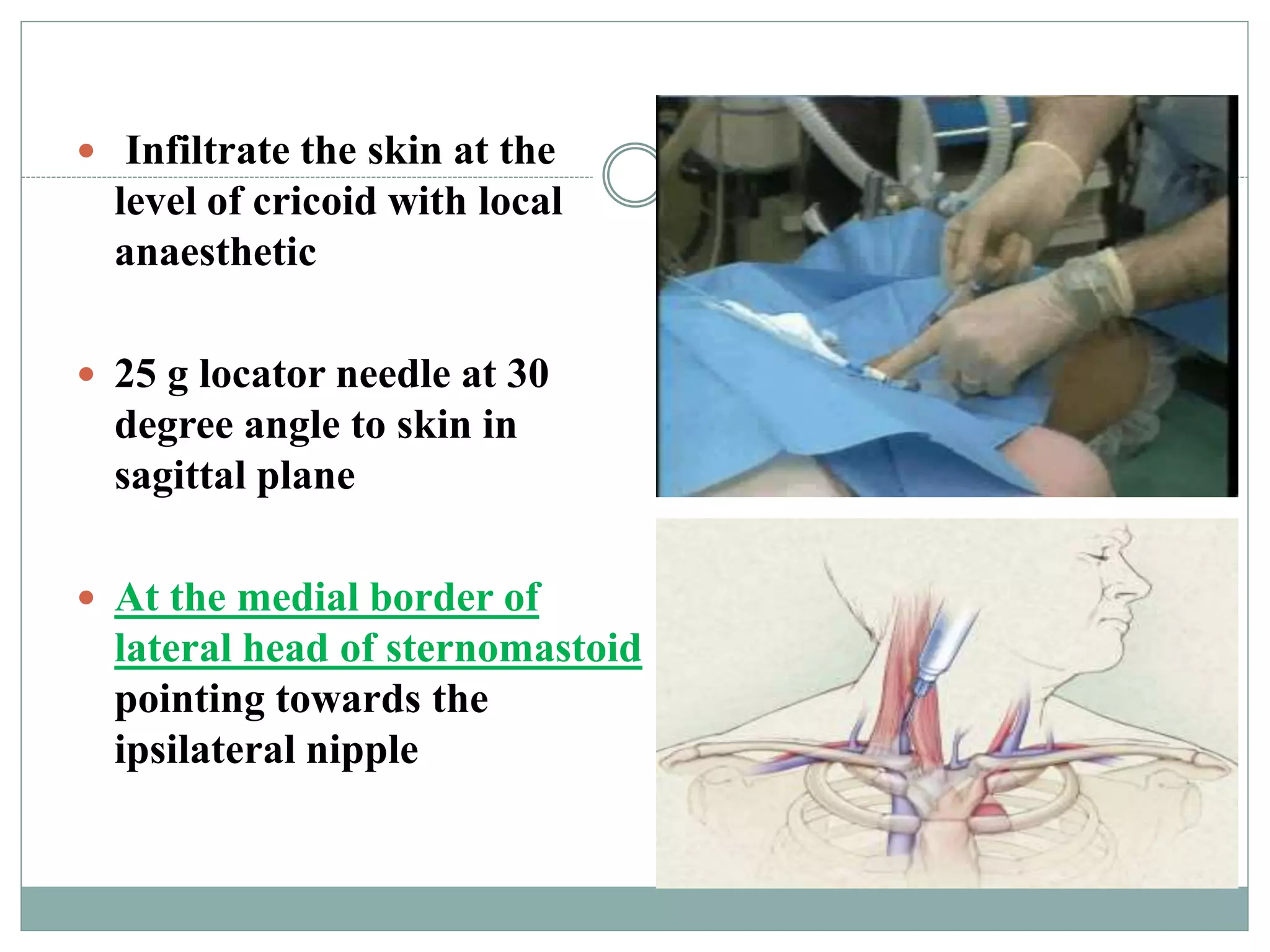 Central venous cannulation | PPTX