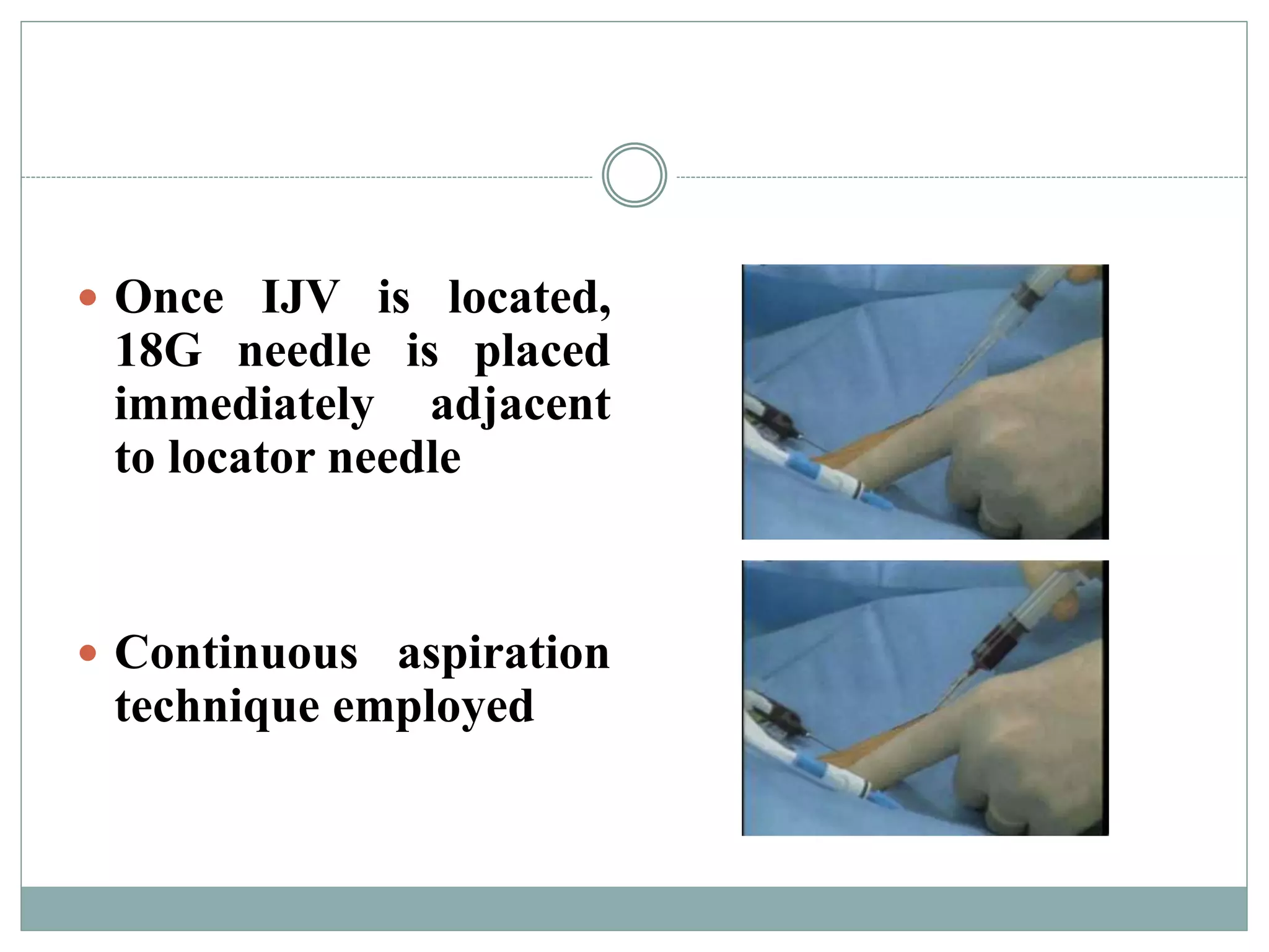 Central venous cannulation | PPTX