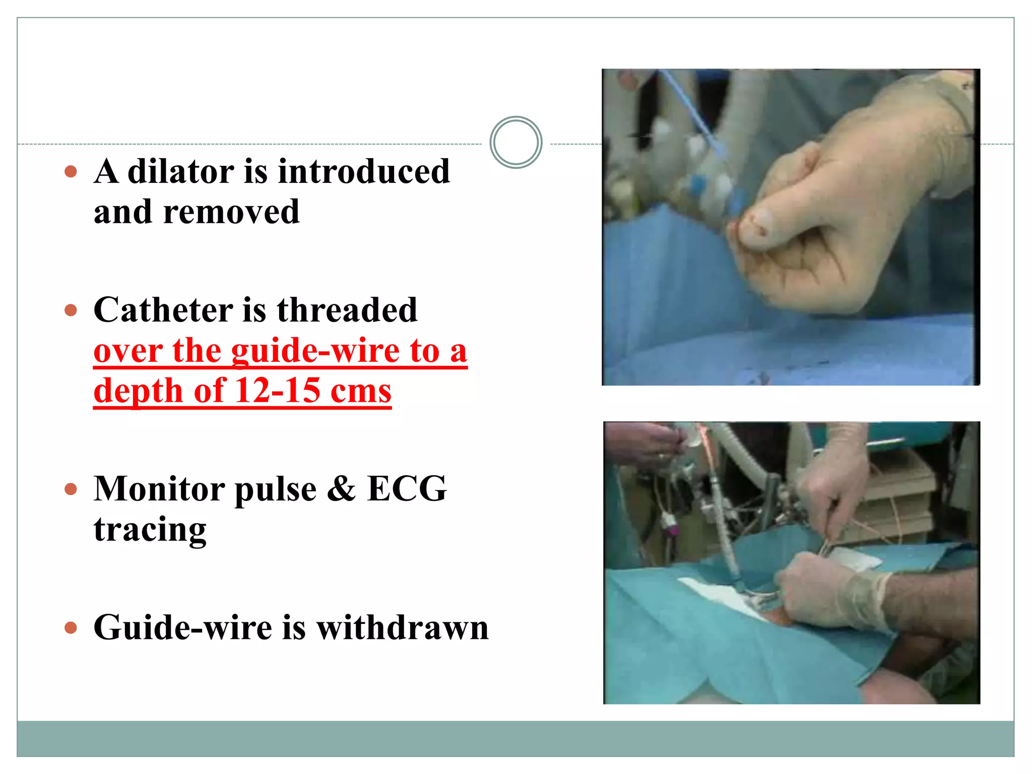 Central venous cannulation | PPTX