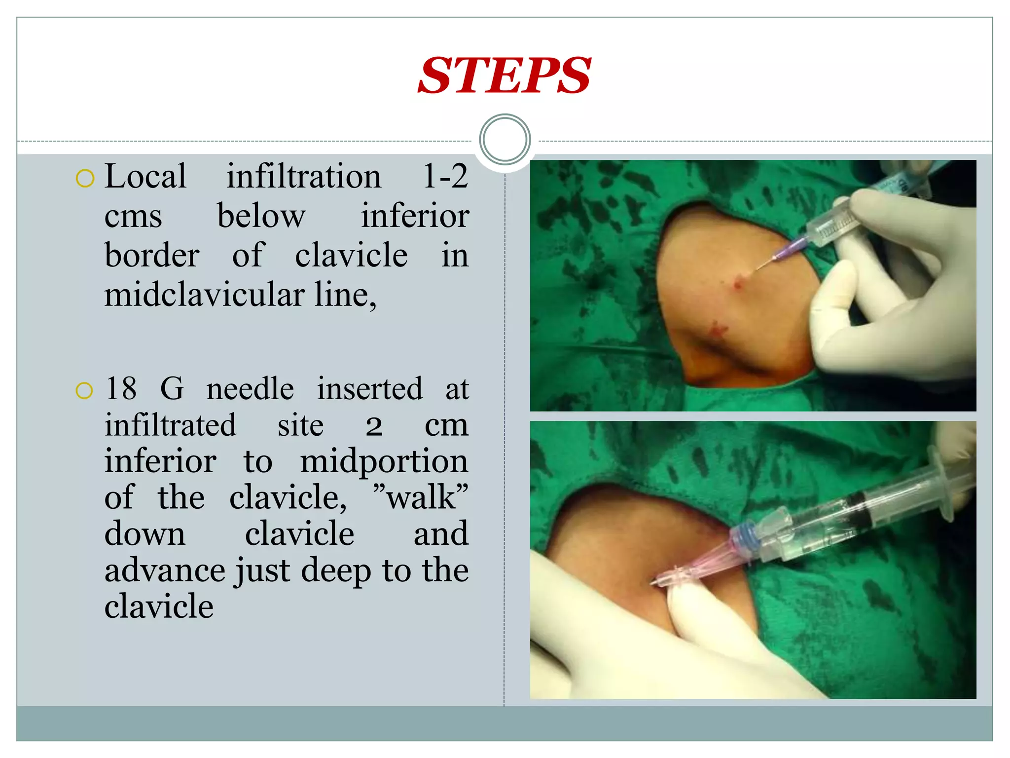 Central venous cannulation | PPTX