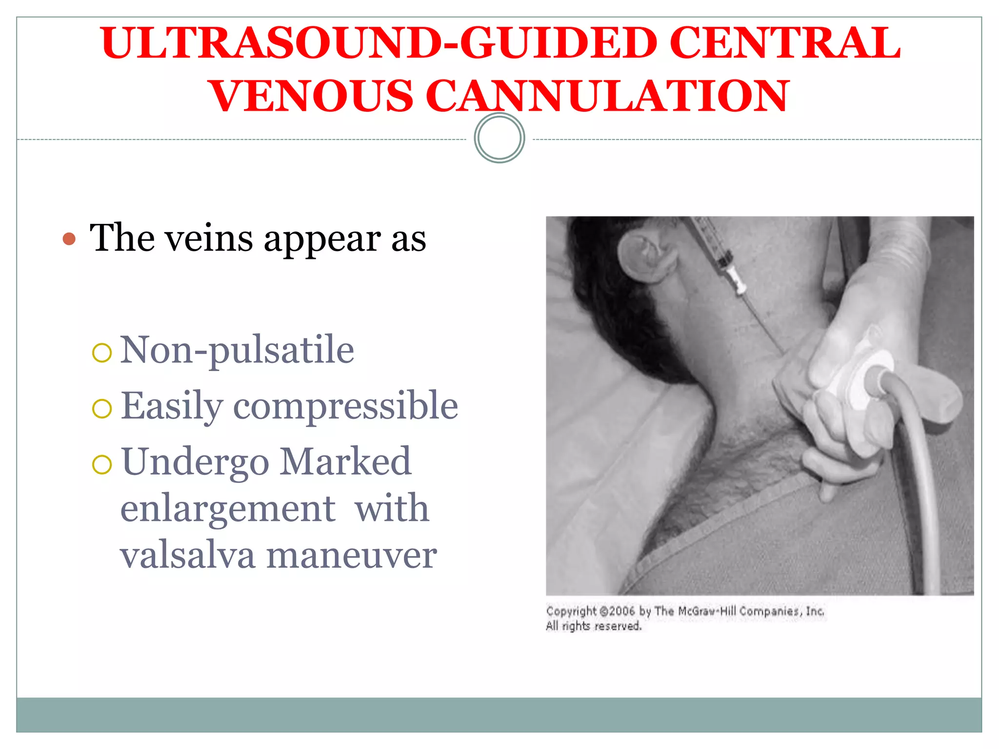 Central venous cannulation | PPTX