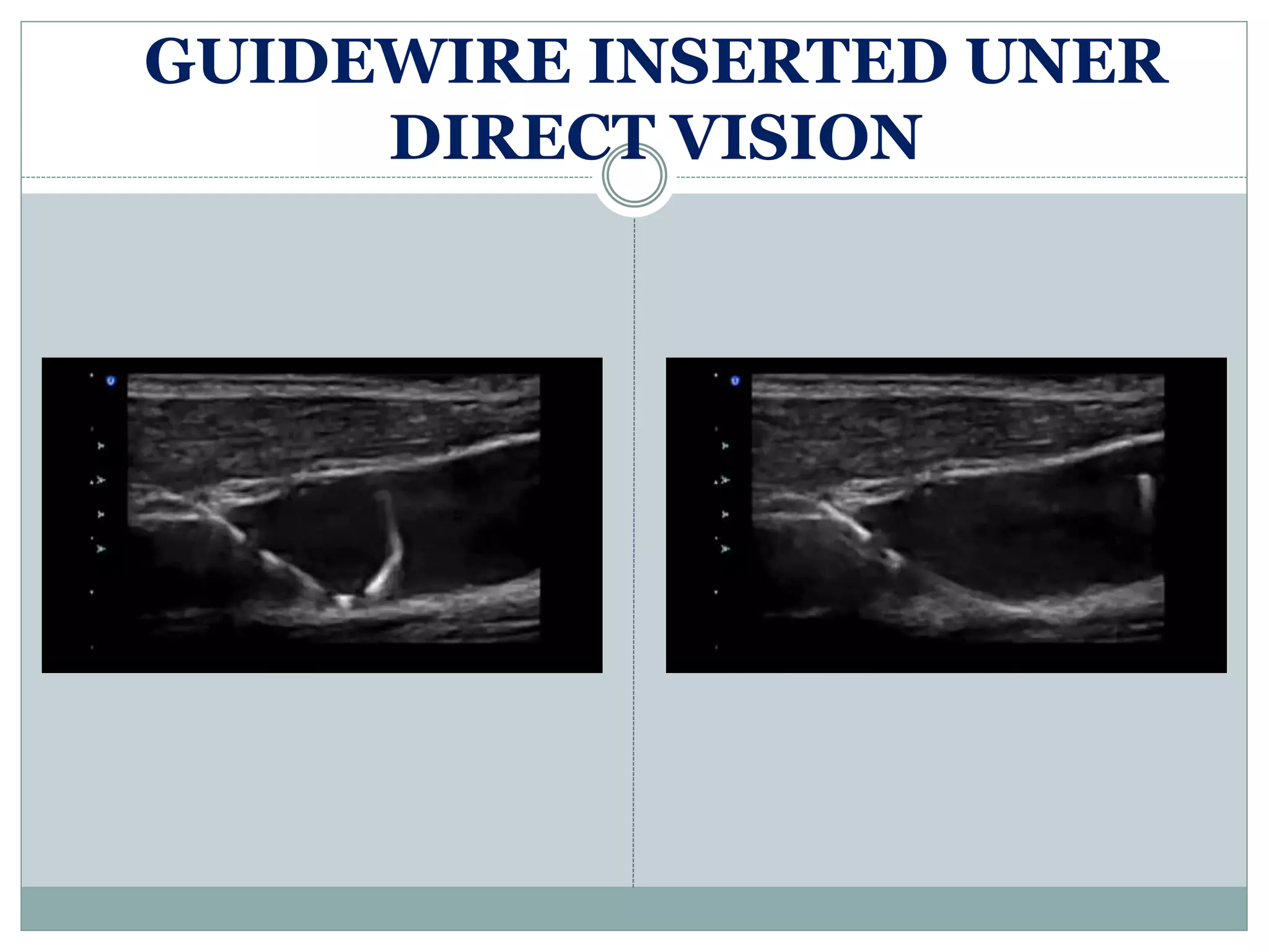 Central venous cannulation | PPTX