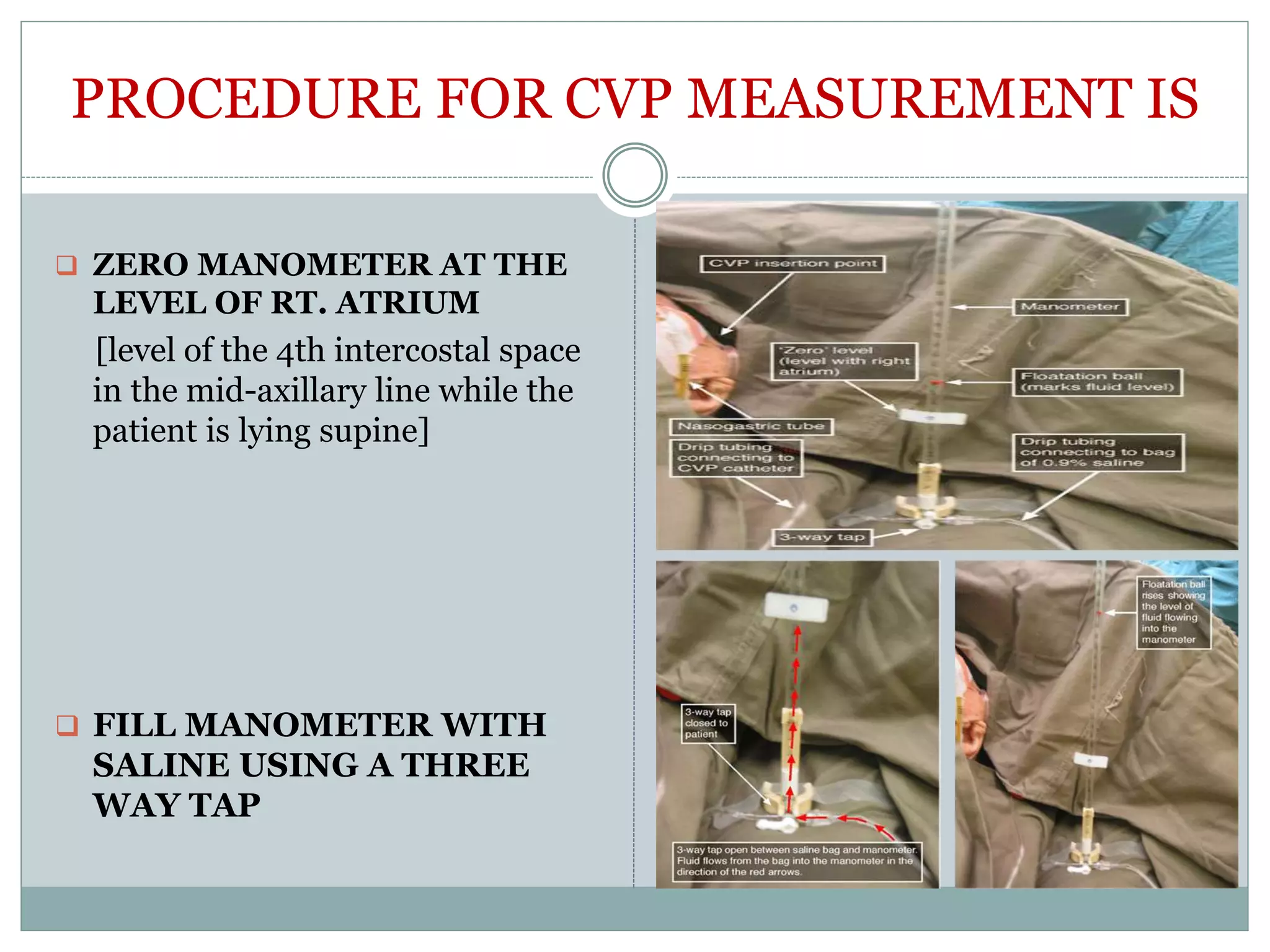 Central venous cannulation | PPTX
