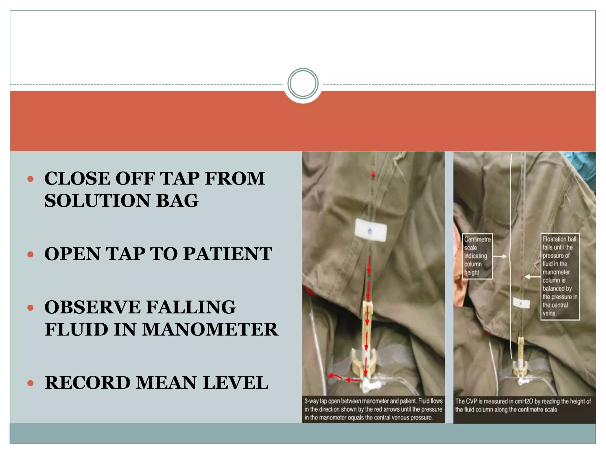 Central venous cannulation | PPTX