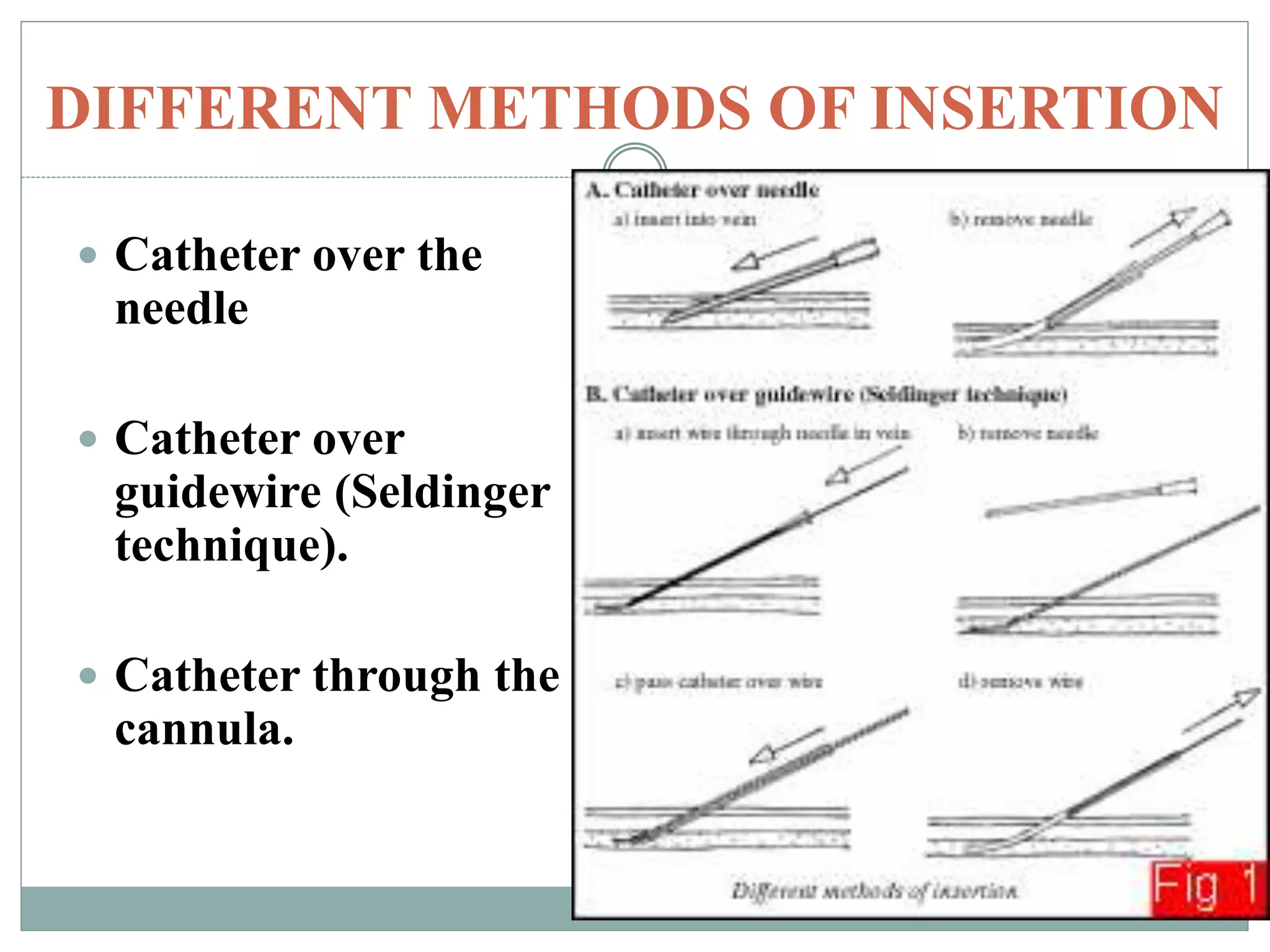 Central venous cannulation | PPTX