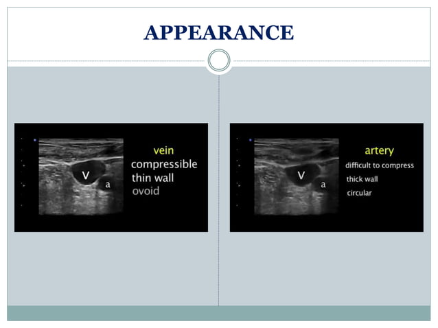 Central venous cannulation | PPTX