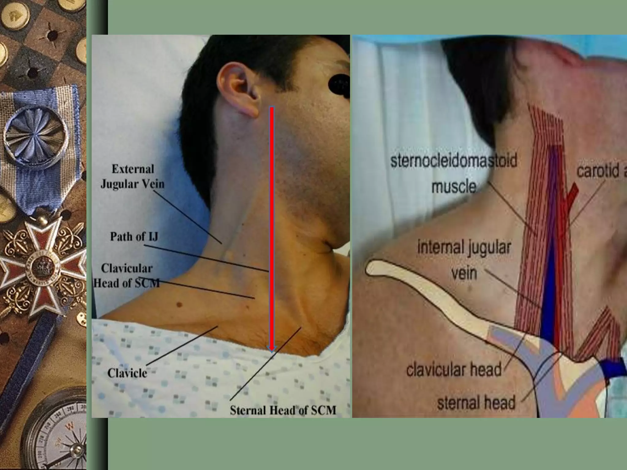 Central venous catheterisation | PPT