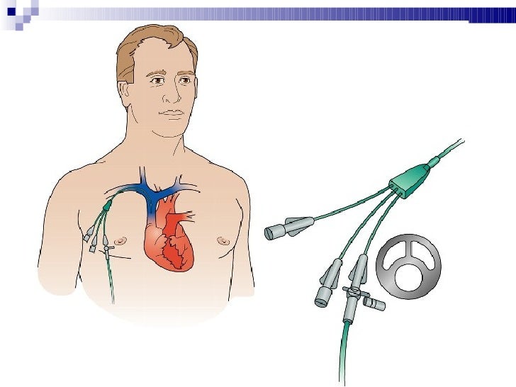 Central venous catheterization