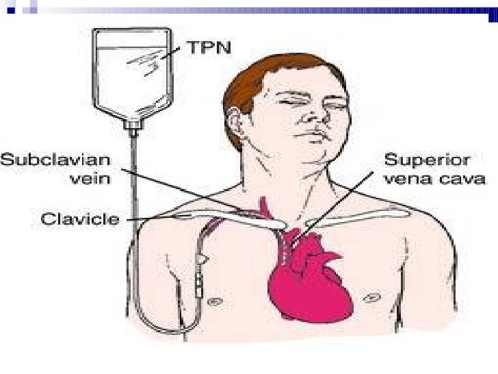 Positioning Of Central Venous Catheter Into The Great