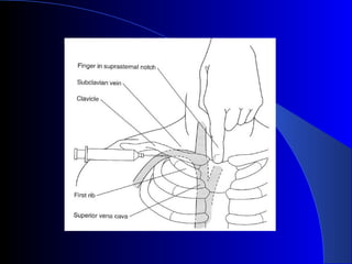 Central venous catheterization | PPT