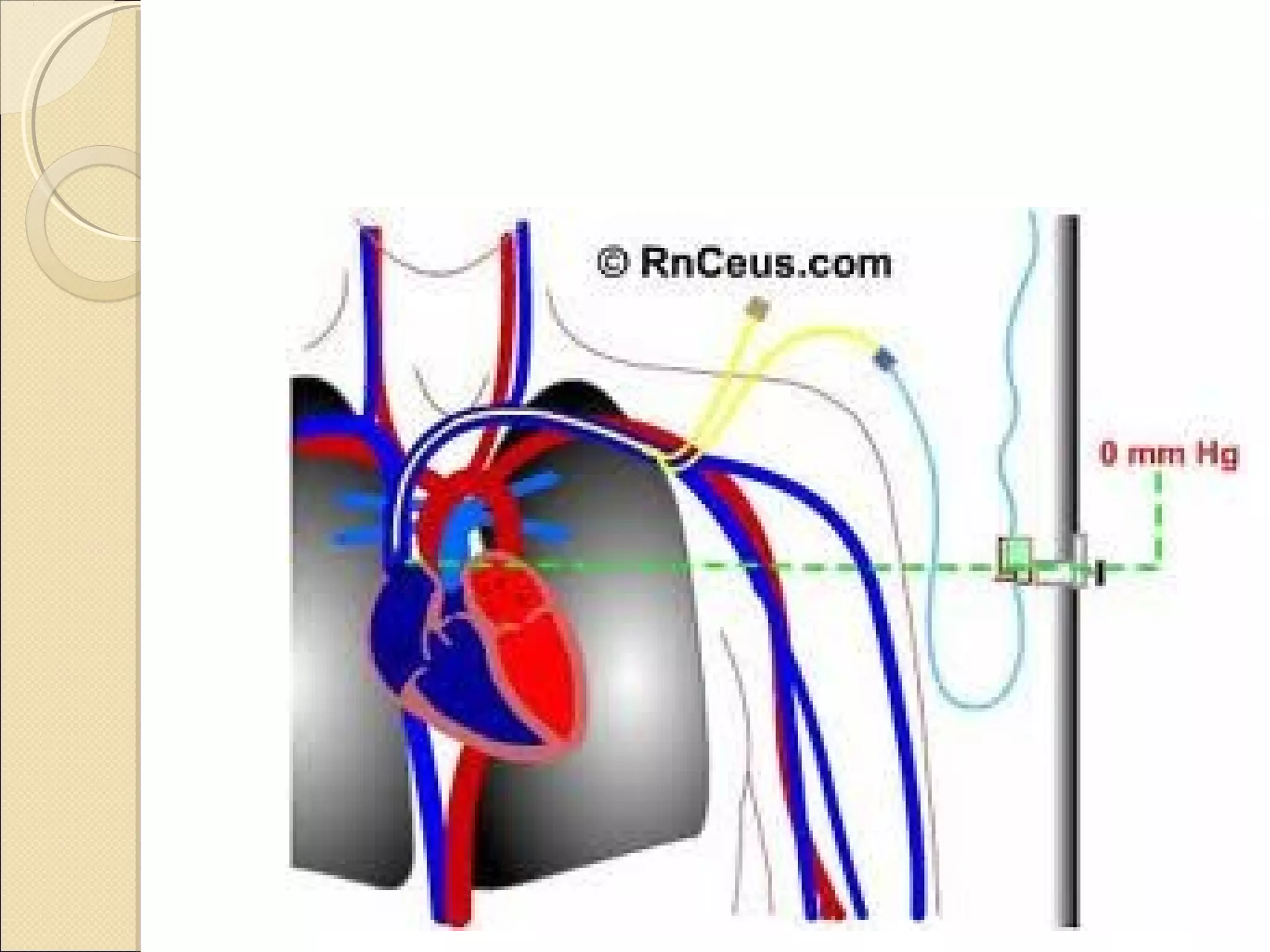 Central venous catheterization | PPT