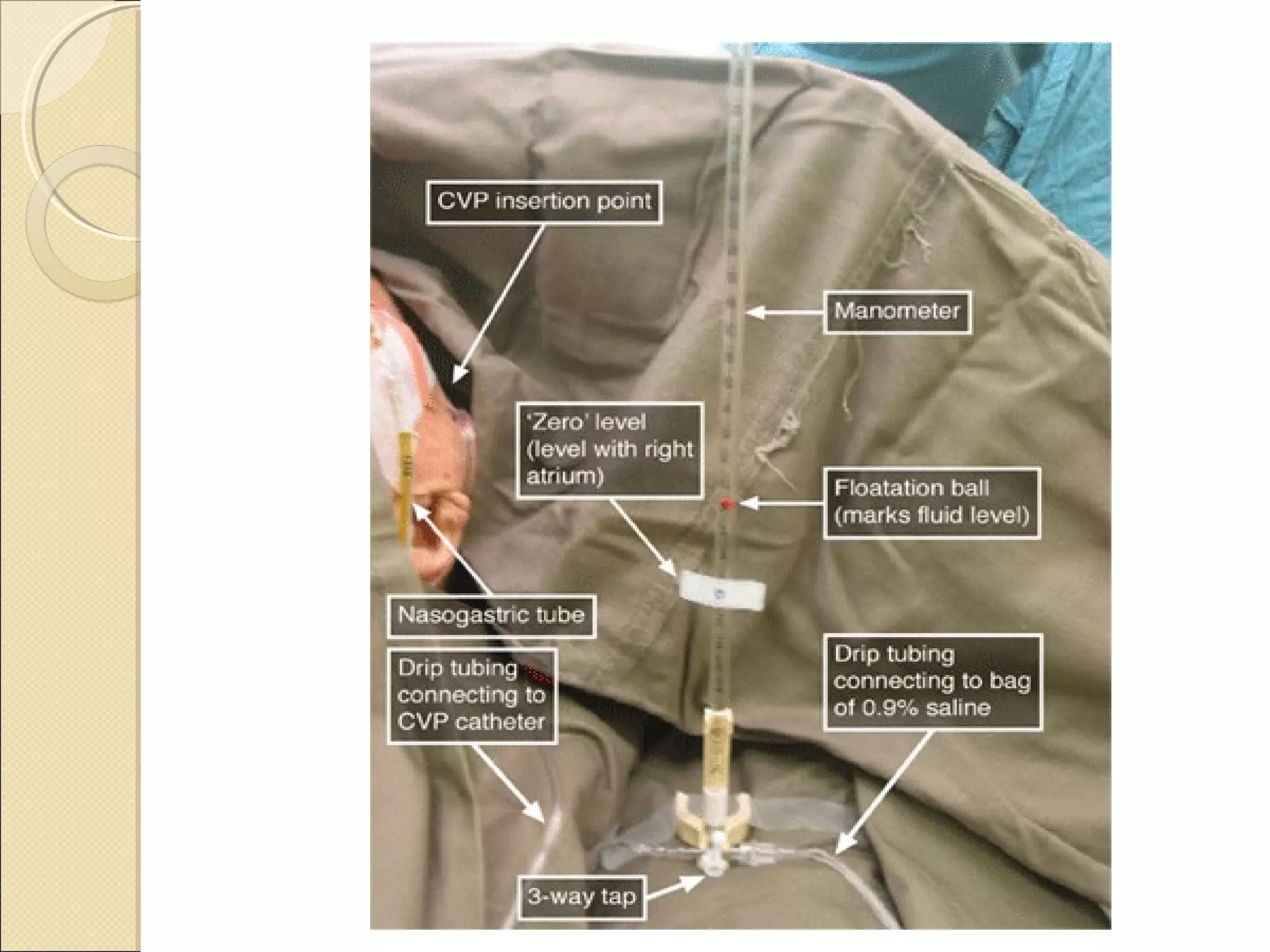 Central venous catheterization | PPT