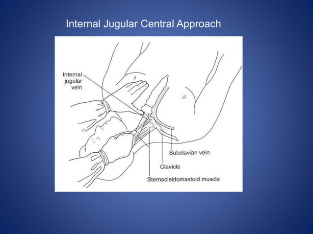 Central venous catheterization | PPTX | First Aid | Injuries
