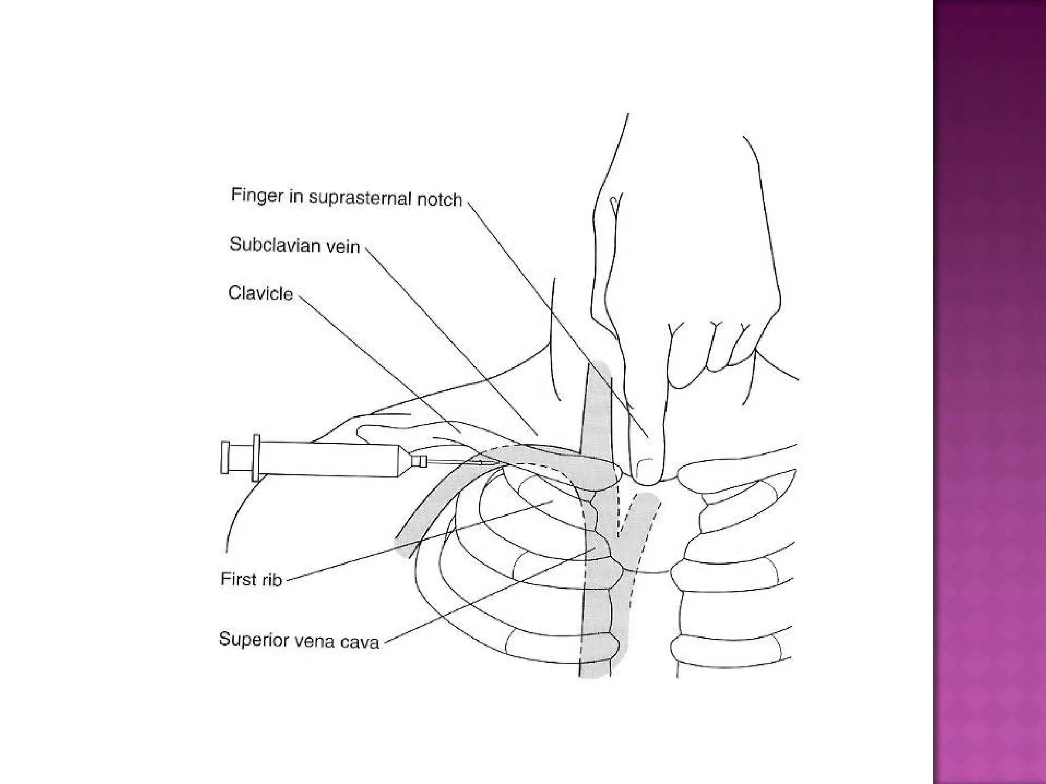 Central venous catheterization | PPT