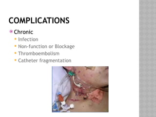 CENTRAL VENOUS CATHETERIZATION FOR CARDIAC | PPTX