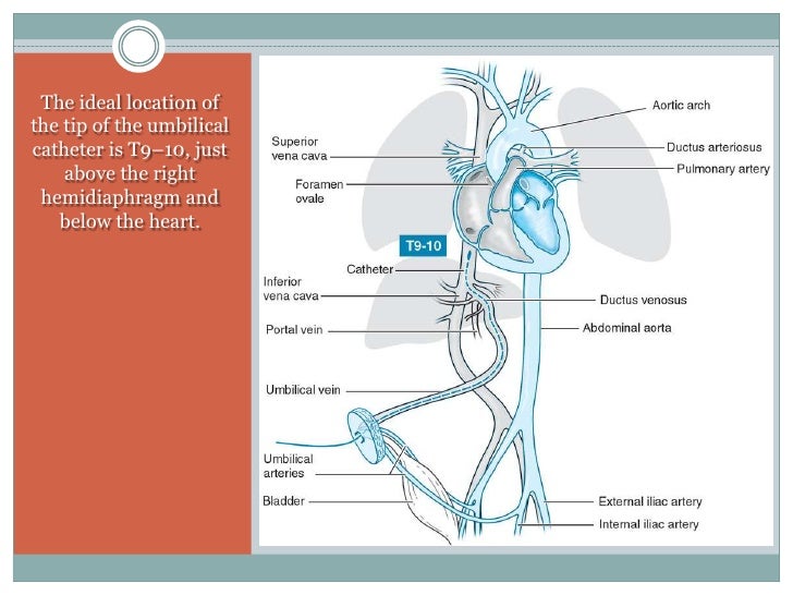 Precautions for Central Venous Catheters in Neonates