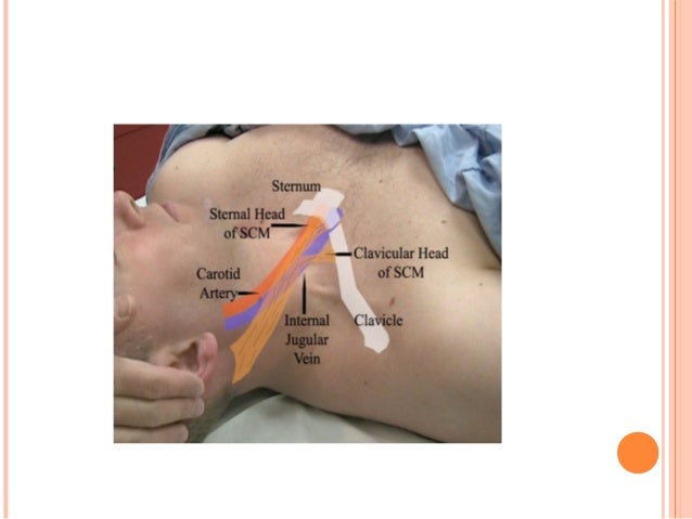 Central venous lines and their problems