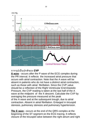 Central venous pressure (cvp) | DOC
