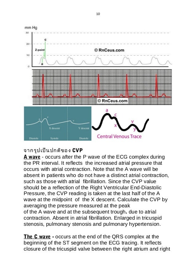 Central venous pressure (cvp)