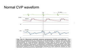CENTRAL VENOUS PRESSURE MONITORINGG.pptx