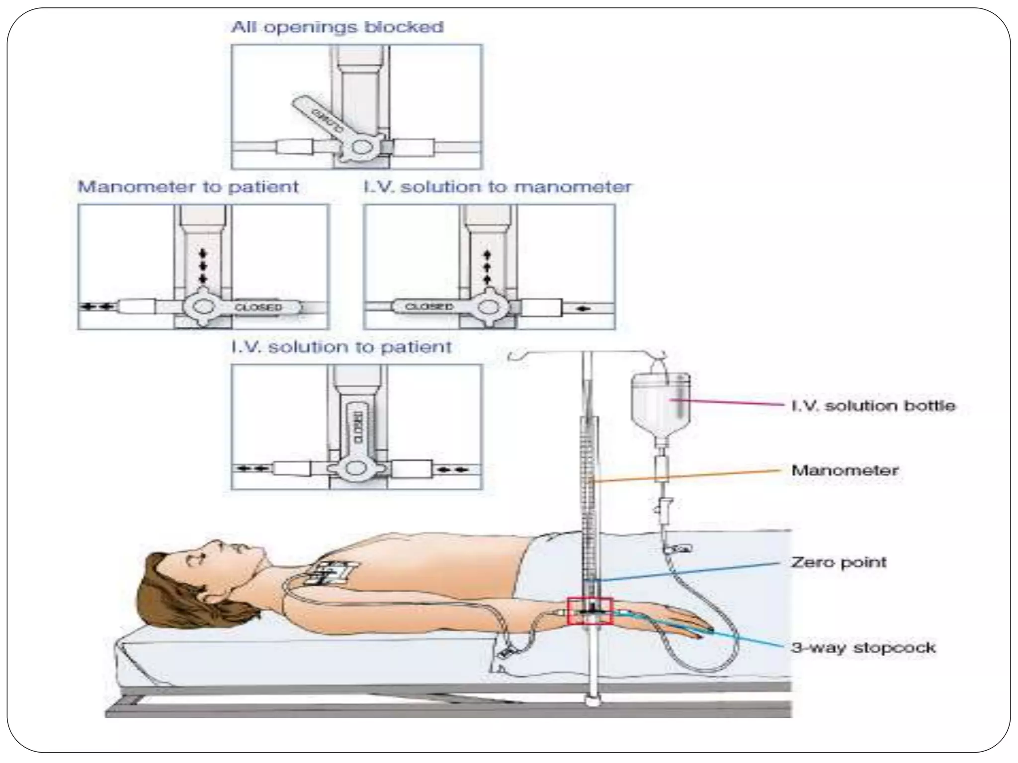 Central venous pressure monitoring | PPTX