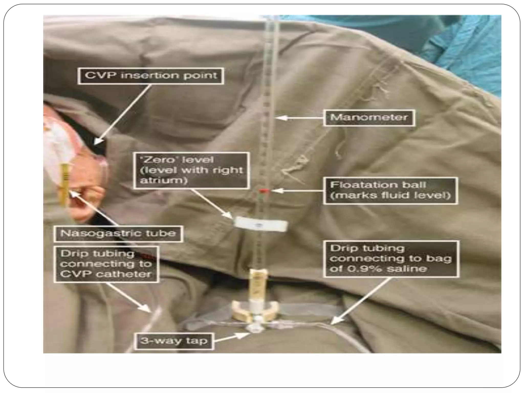 Central venous pressure monitoring | PPTX