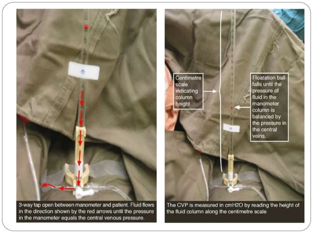 Central venous pressure monitoring | PPTX