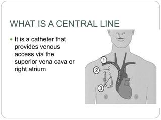 Measuring Central Venous Pressure