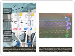 Central venous pressure monitoring | PPT