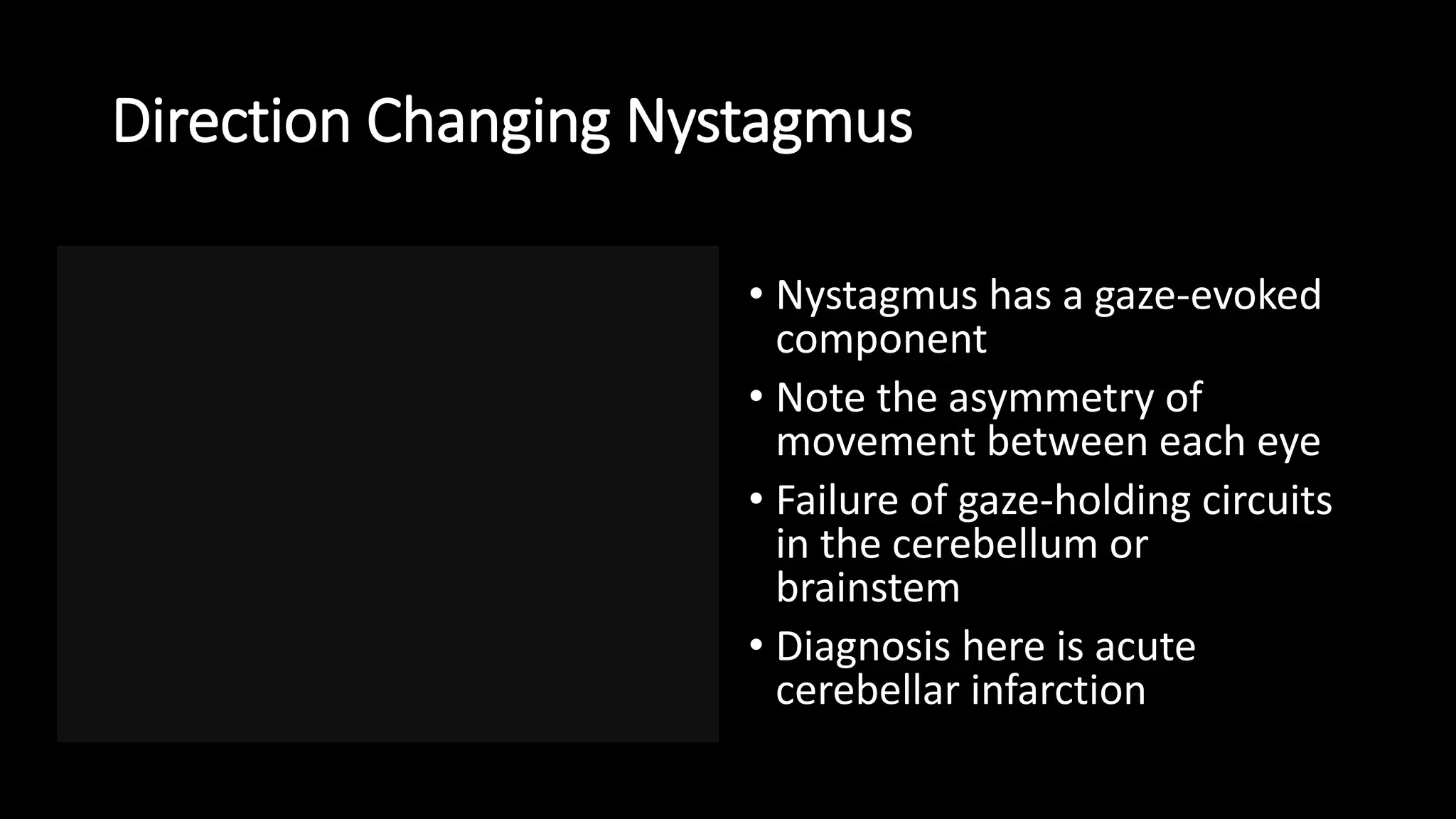 Central vertigo and nystagmus | PPTX