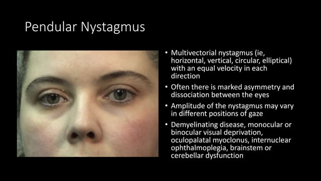 Central vertigo and nystagmus | PPTX | Eye and Vision Conditions ...