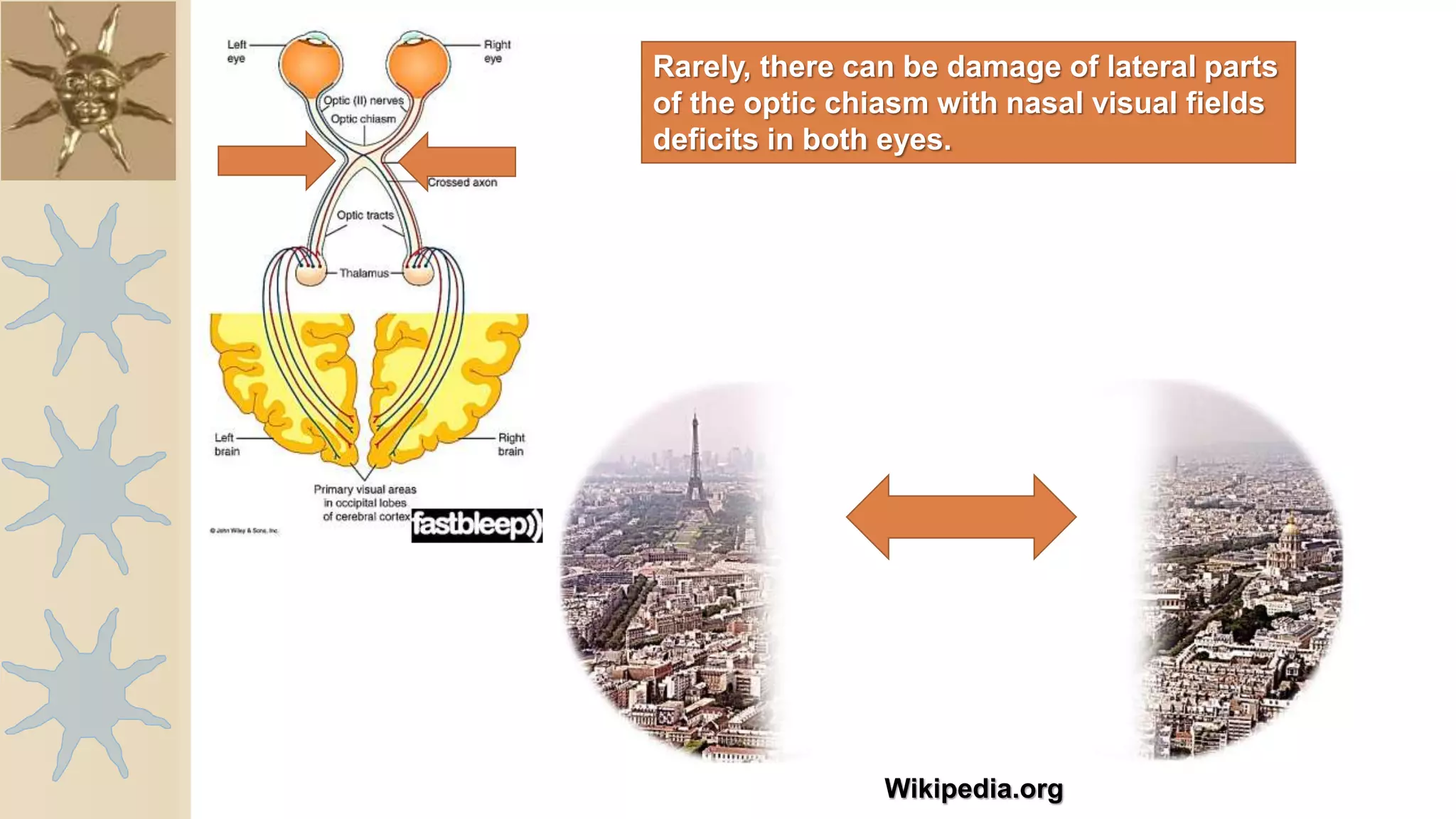 Central visual pathways | PPSX | Eye and Vision Conditions | Diseases ...