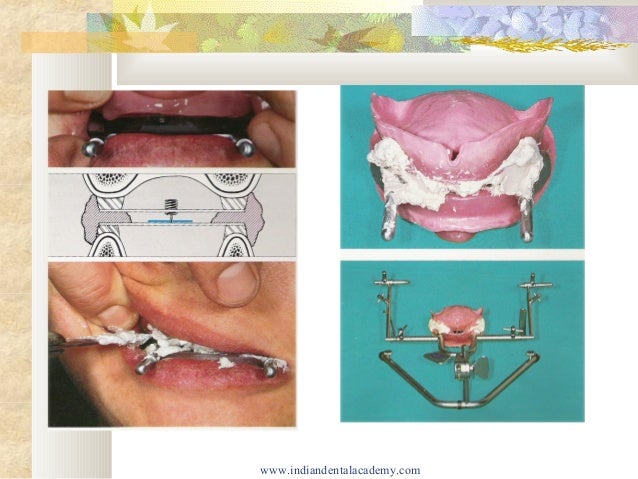 Centric and eccentric jaw relation / dental courses
