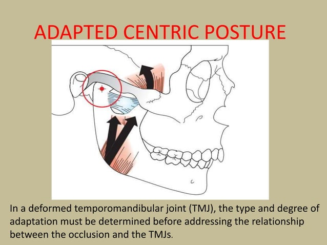 CENTRIC RELATION.pptx