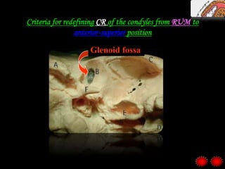centric relation in complete denture prosthodontics | PPT