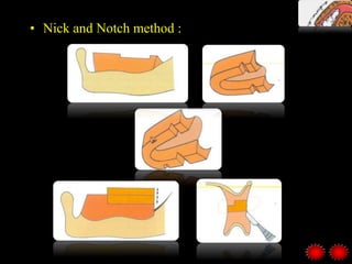 centric relation in complete denture prosthodontics | PPT