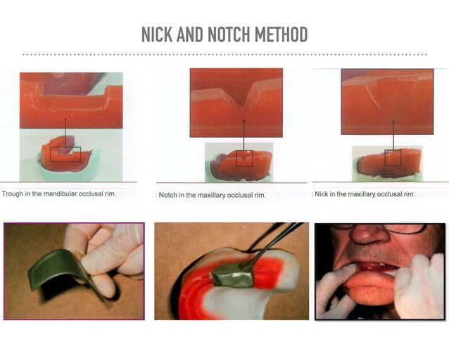 Centric relation seminar | PDF | Dental Health | Diseases and Conditions