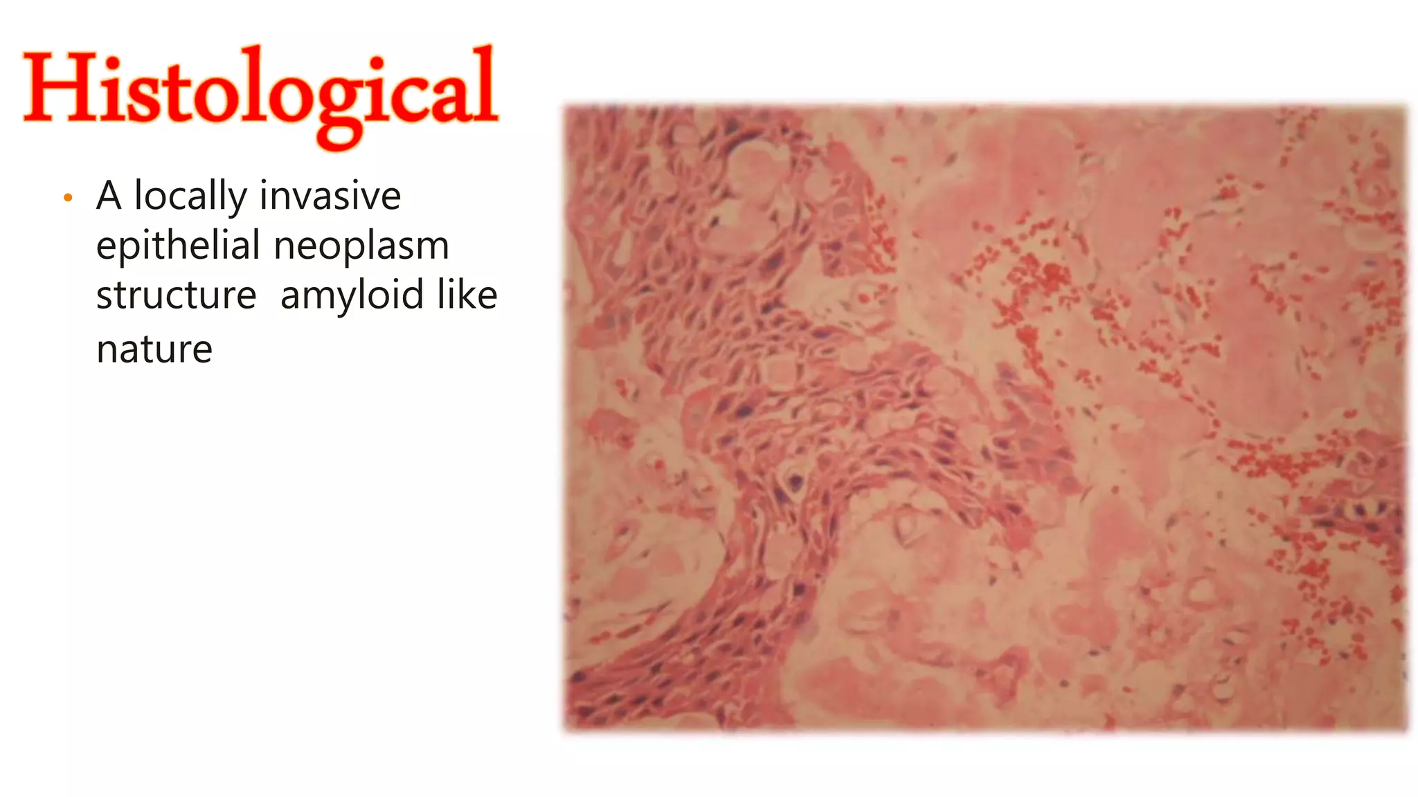 calcifying epithelial odontogenic tumor Ceot | PPTX