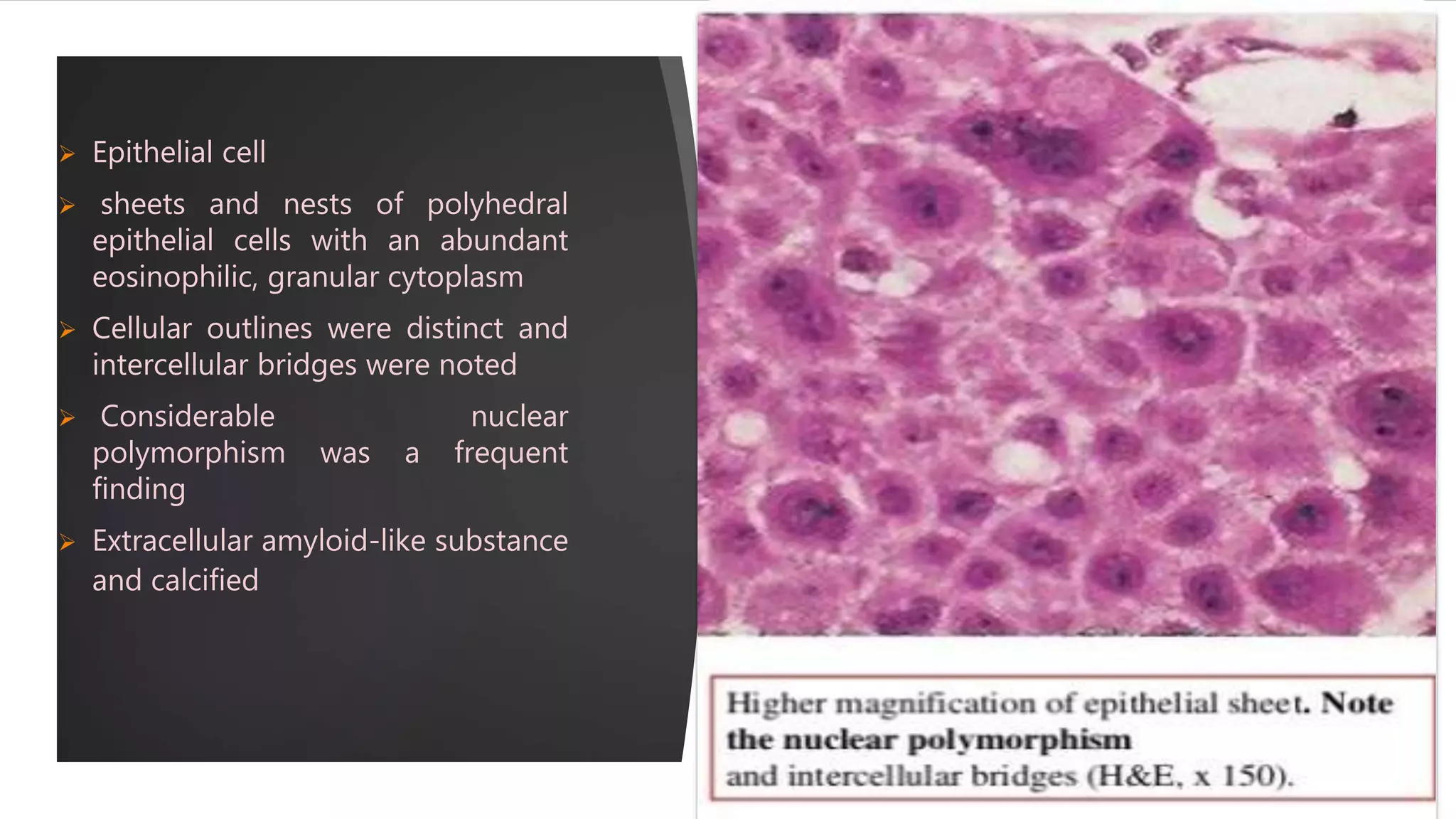calcifying epithelial odontogenic tumor Ceot | PPTX