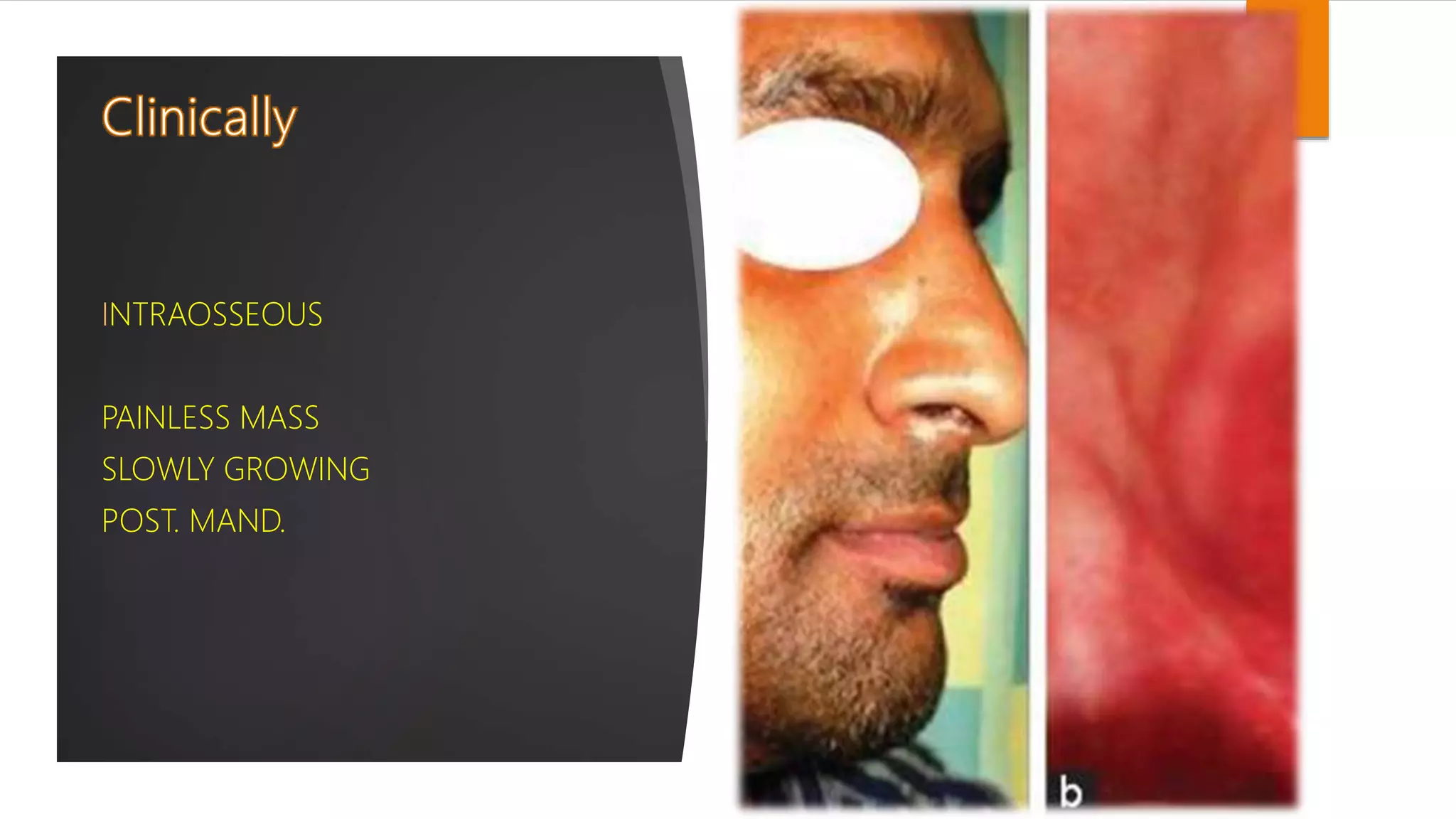 calcifying epithelial odontogenic tumor Ceot | PPTX