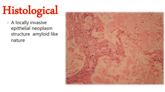 calcifying epithelial odontogenic tumor Ceot | PPTX