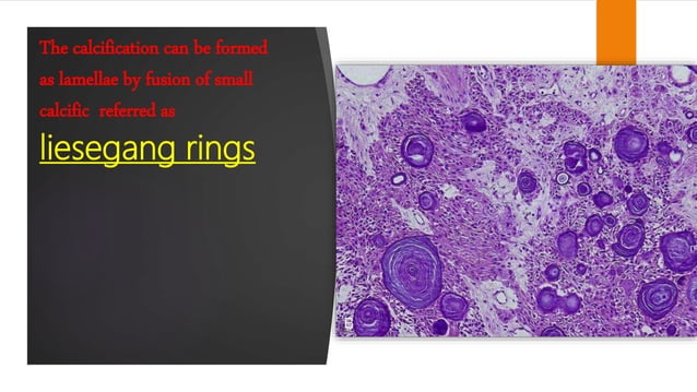 calcifying epithelial odontogenic tumor Ceot | PPTX
